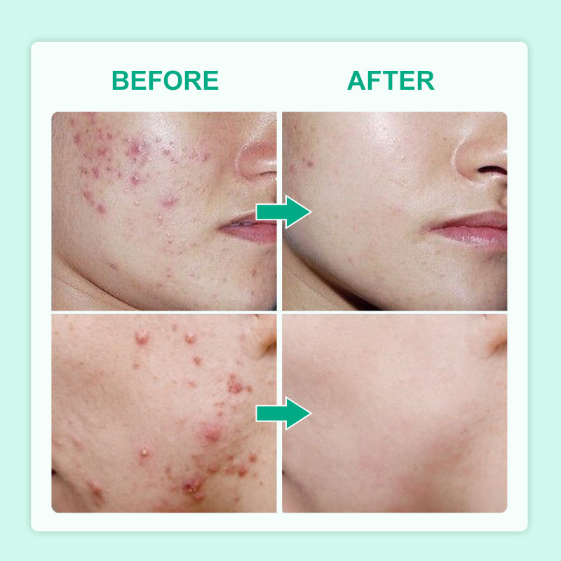 JellyPrim Double Effect Acne Removing Serum - Private Label Skincare ...