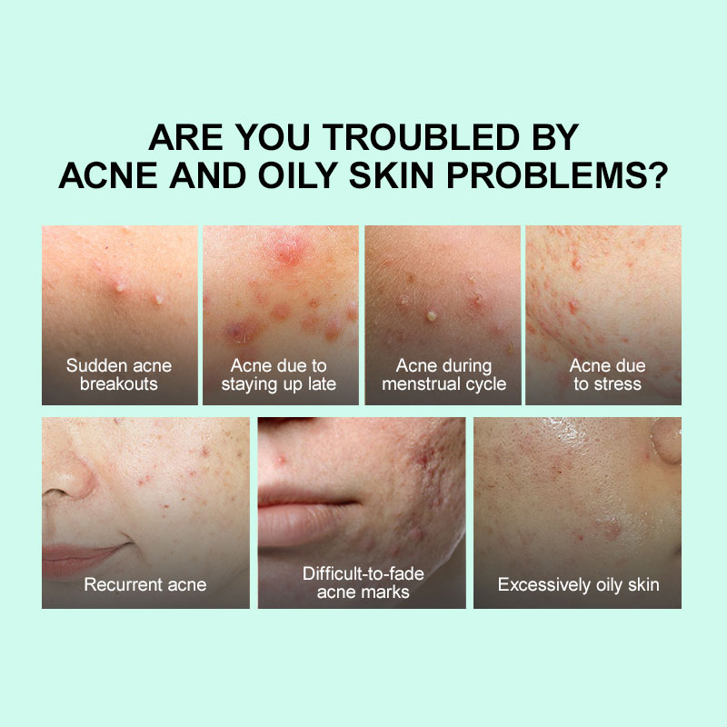 JellyPrim Double Effect Acne Removing Serum - Private Label Skincare ...